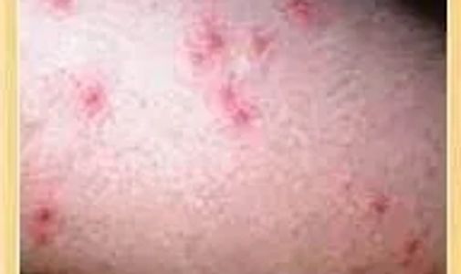 Folliculitis Treatment - Advanced Dermatology Specialists